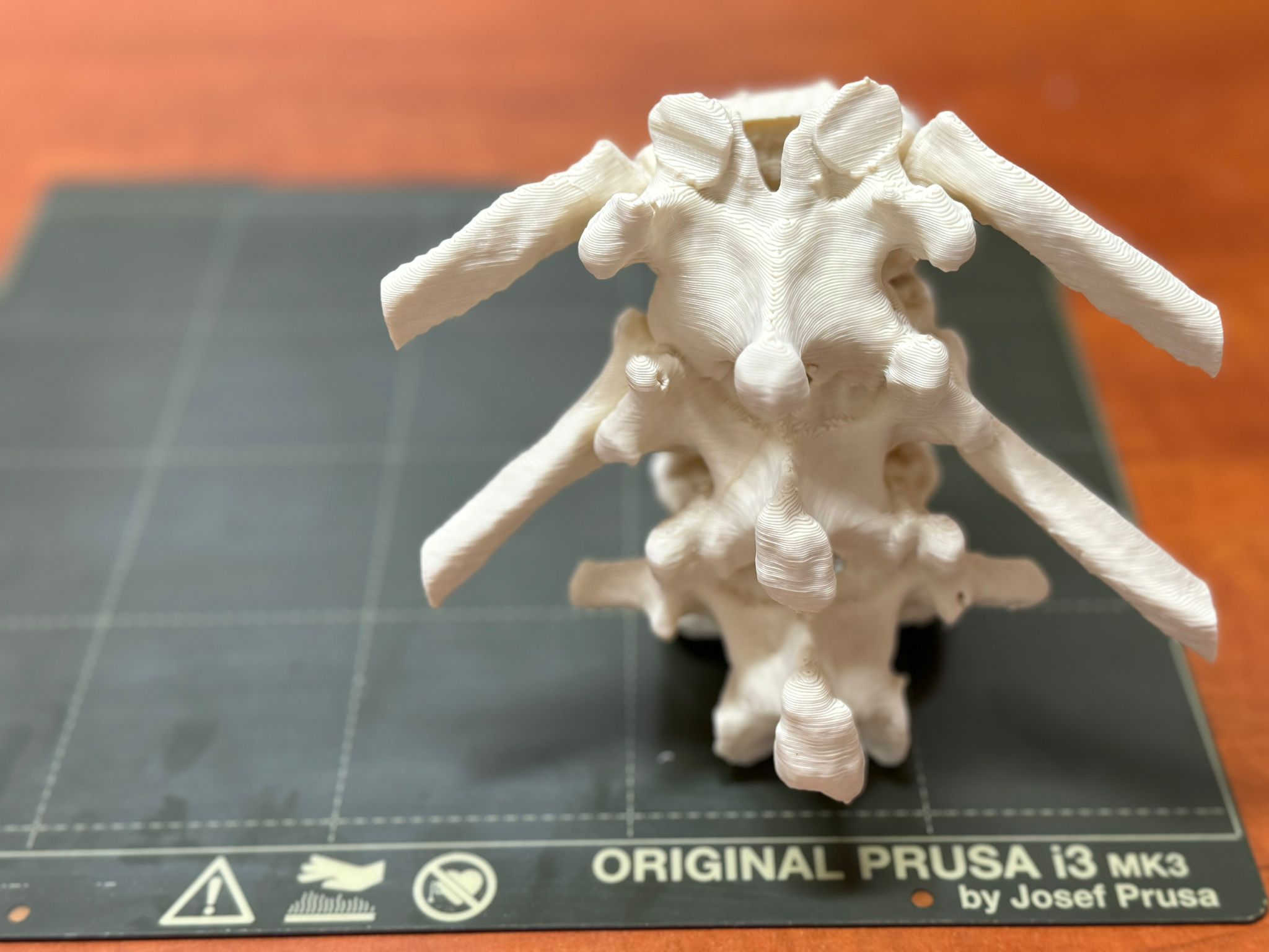 Vertebral fracture / zlomenina obratle by 1. chirurgická klinika 1 ...