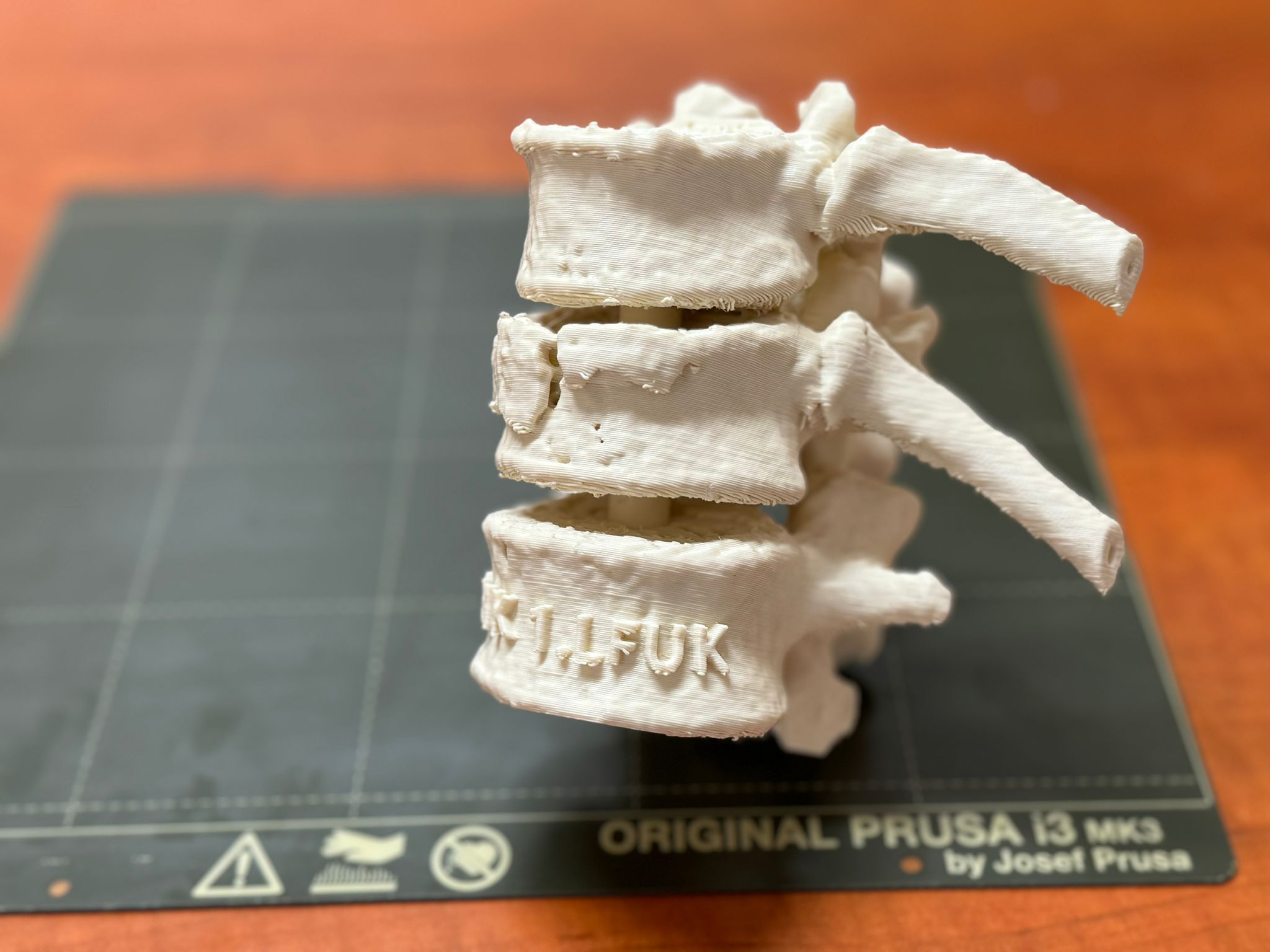 Vertebral fracture / zlomenina obratle by 1. chirurgická klinika 1 ...