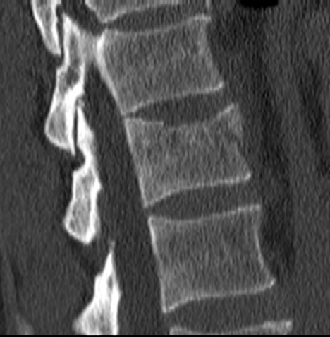 Vertebral fracture / zlomenina obratle by 1. chirurgická klinika 1 ...