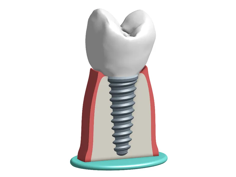 Tooth implant model by Thorin Oakenshield | Download free STL model ...