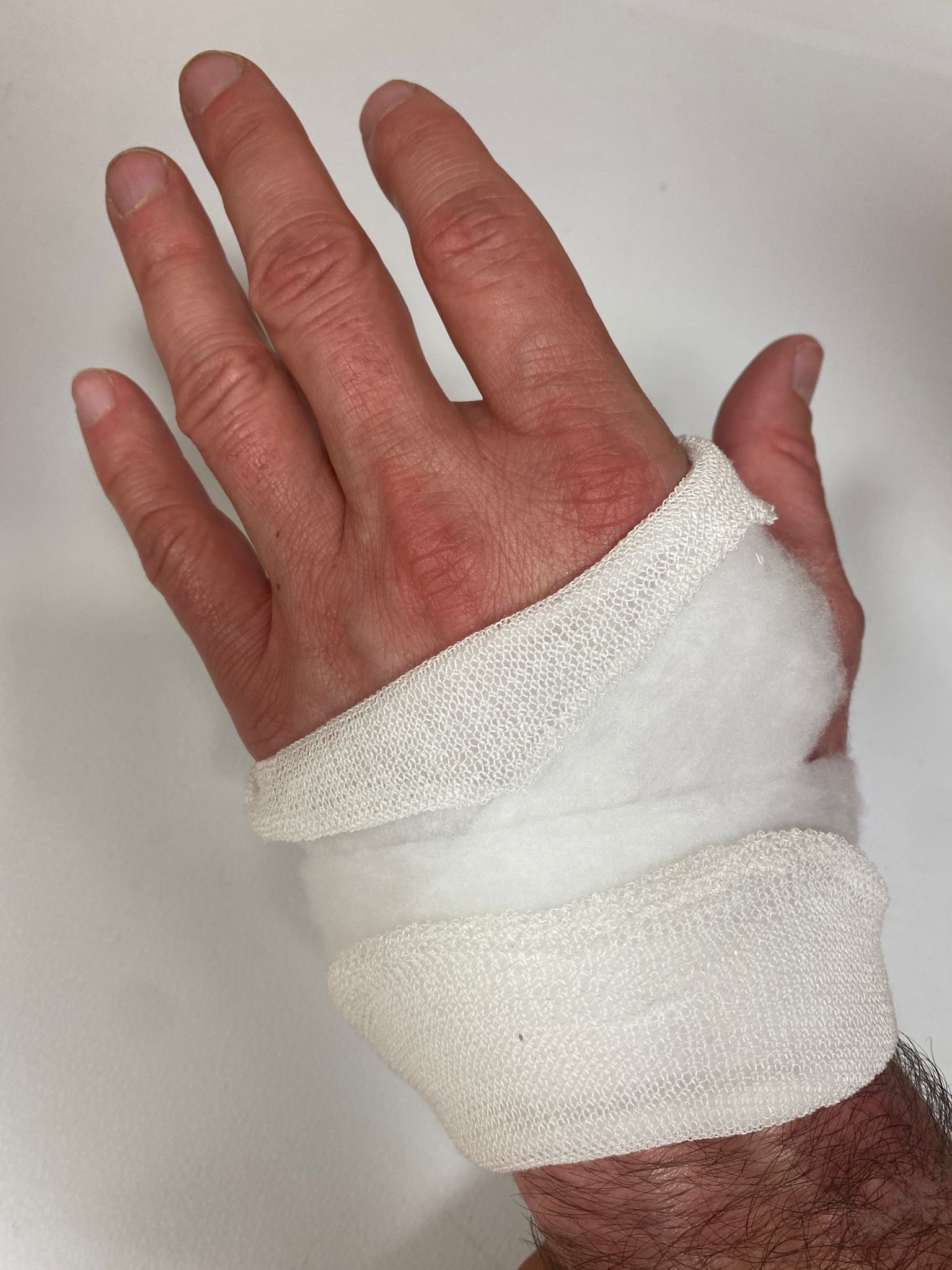 Pinky finger/thumb brace (splint) by Prusa Research | Download free STL ...