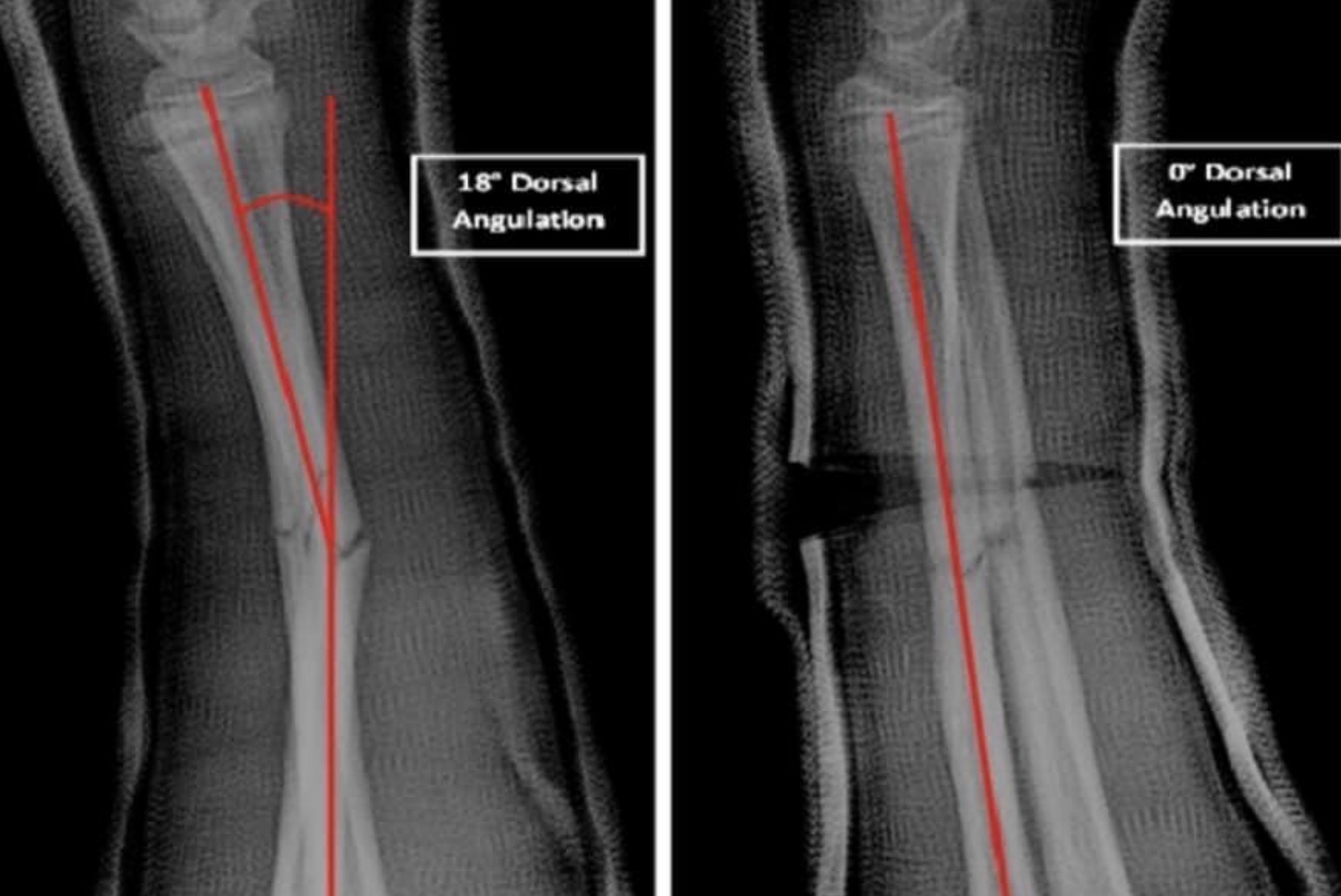 Cast wedge by Bcare001 | Download free STL model | Printables.com