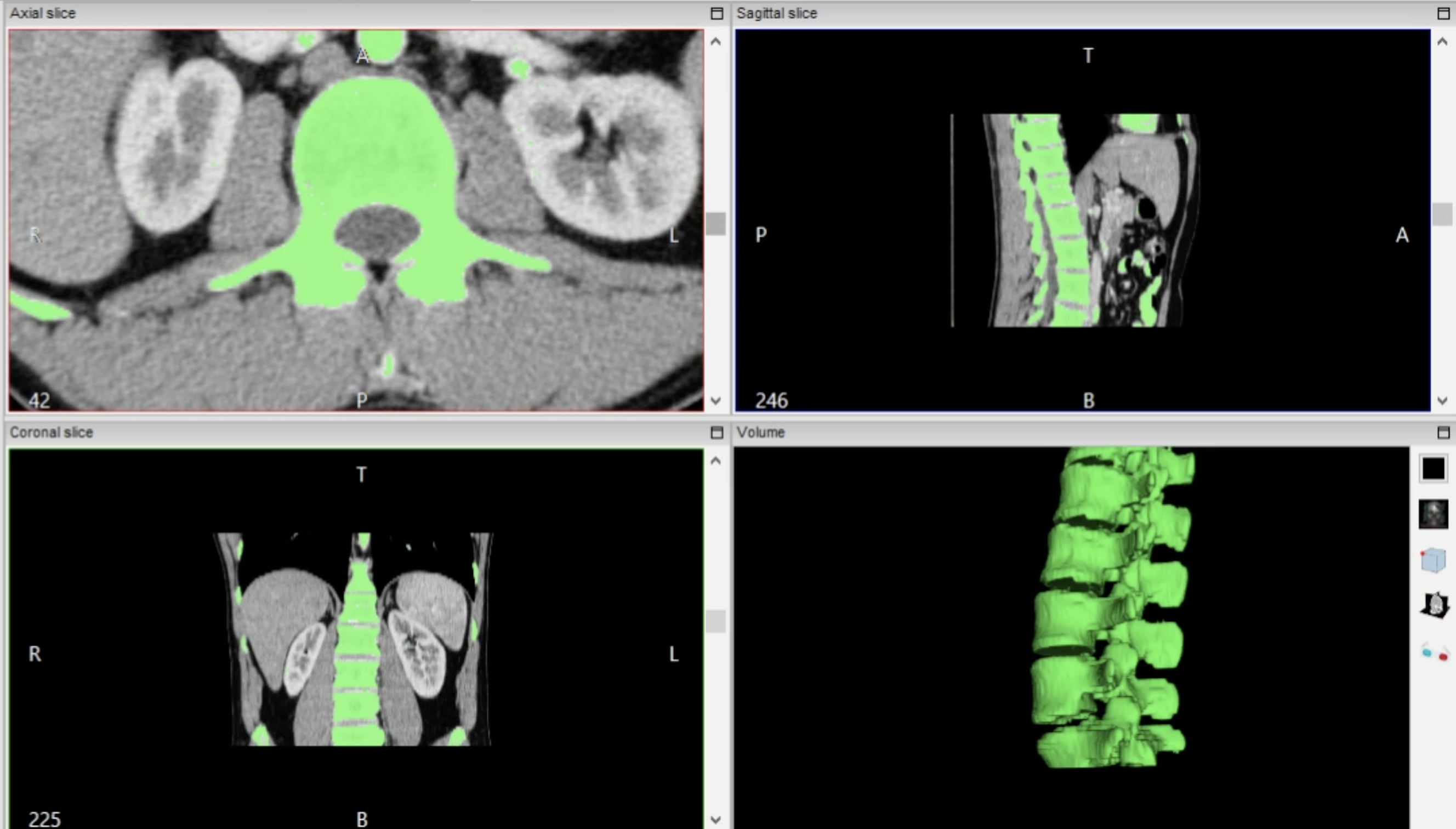 Spine Model from CT Scan / Printable Medical Model par Andrew_Sink ...