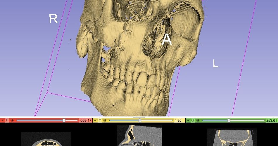 Human Skull (front halve) by mechadense | Download free STL model ... Human Skull (front halve) by mechadense | Download free STL model ...