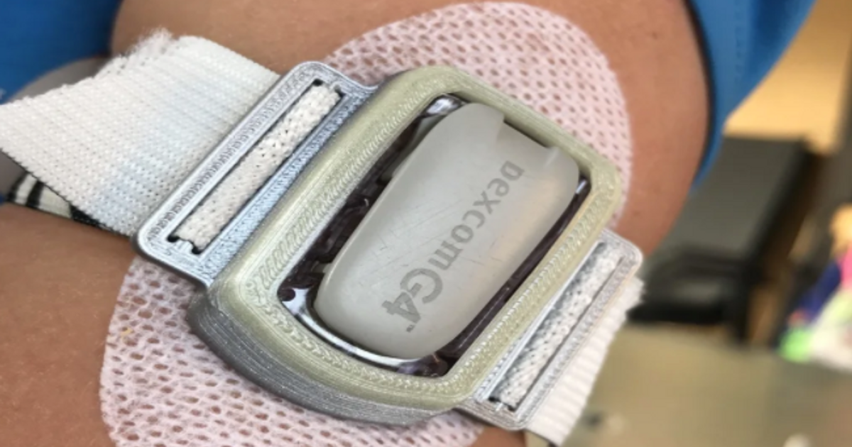 Dexcom G4/G5 cover by Martin Kolář | Download free STL model ...