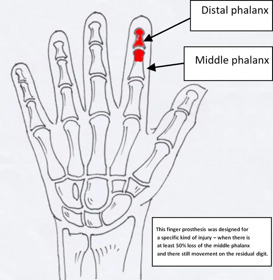 BioMech Finger Prosthesis (Index Left Hand) by Maximilium XYZ ...