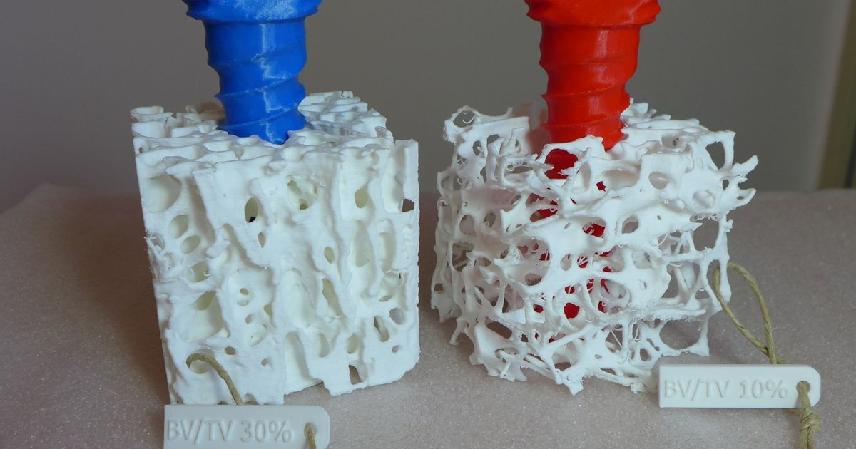 Trabecular bone osteoporosis model with bone screw by akimakes ...