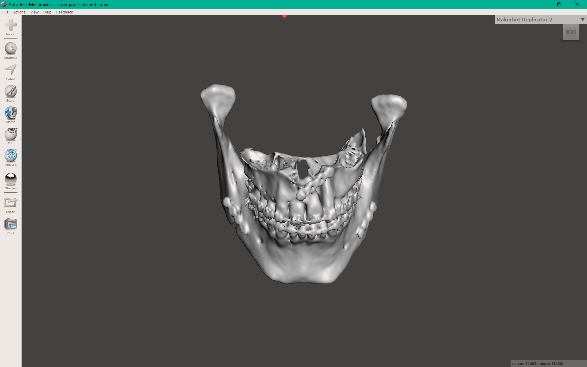 Maxilla and mandible after Bijaw surgery by Metal_mouth | Download free ...