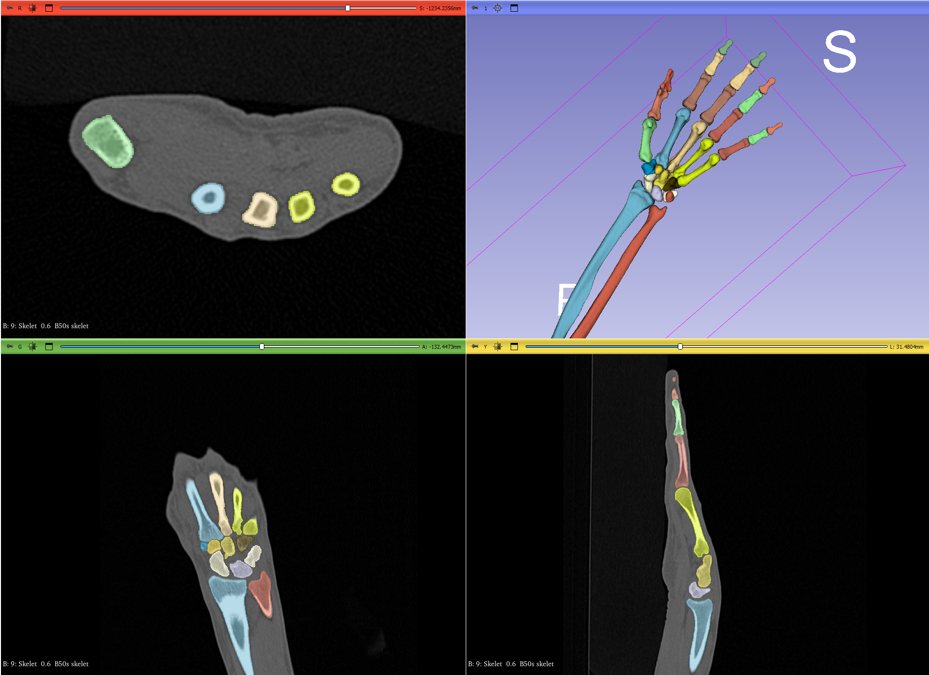 Life-sized Flexible Forearm by Karel Pěnička | Download free STL model ...