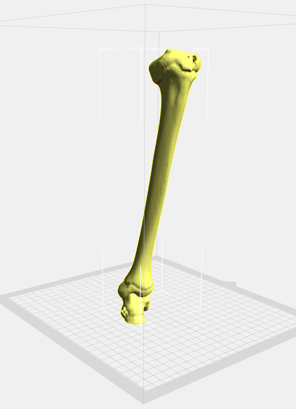 Adolescent Tibia Vara - Detailed Orthopedic Educational Tool by David ...