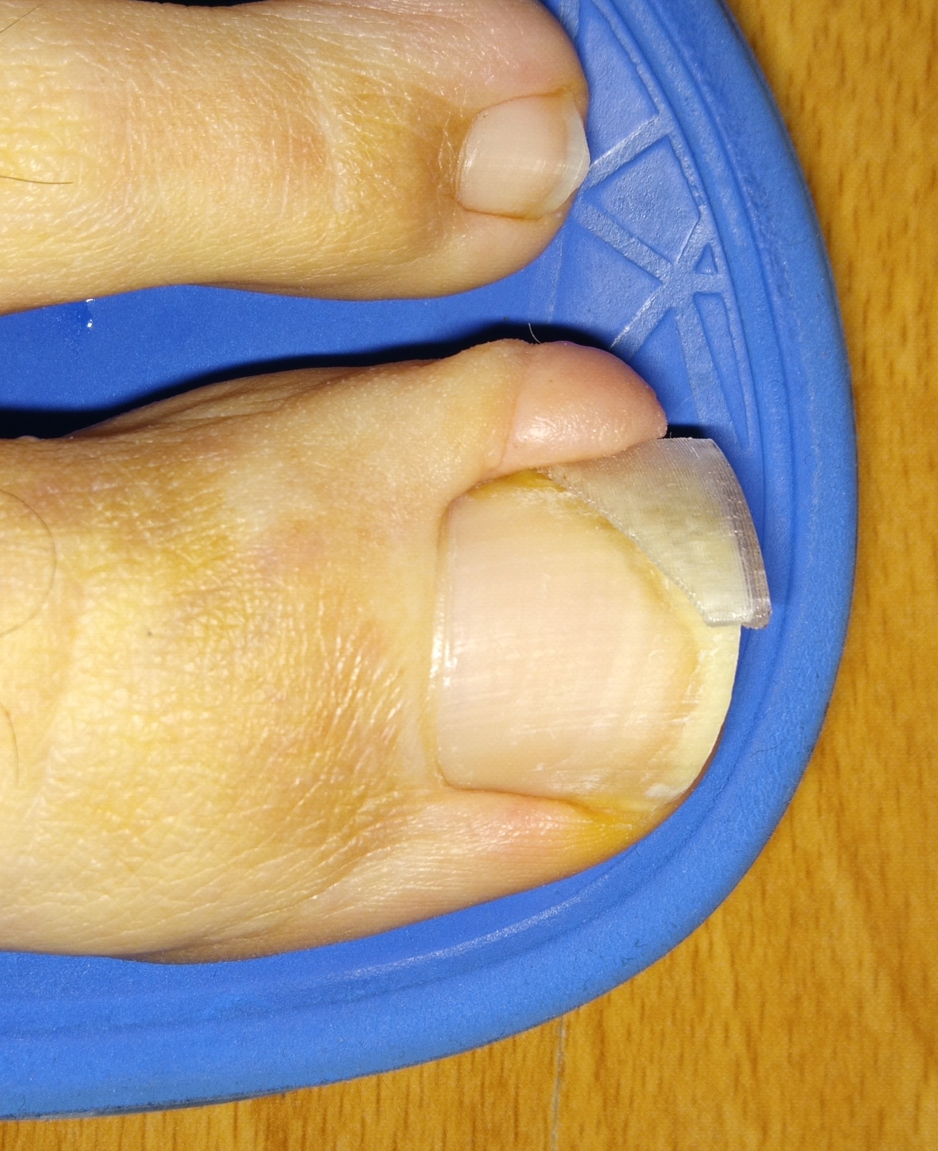 Toenail protective cover by theo | Download free STL model | Printables.com